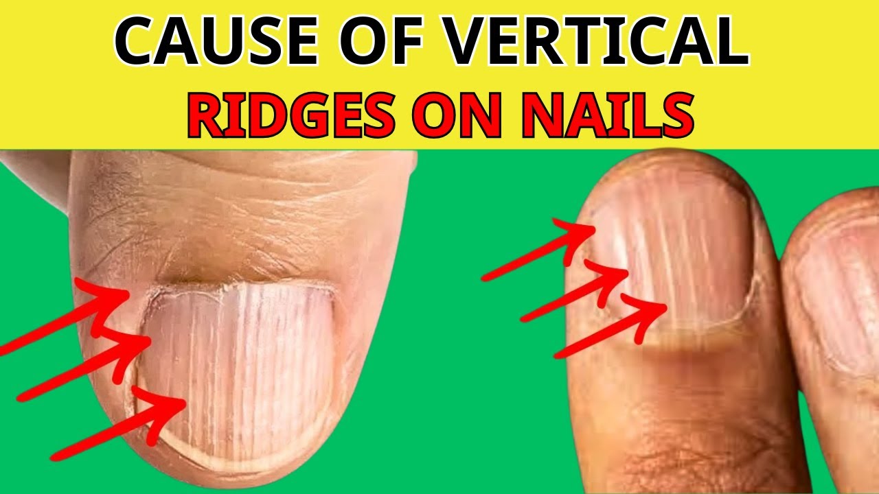 Vertical Nail Ridges – The Mysterious Signs of Your Body! - YouTube