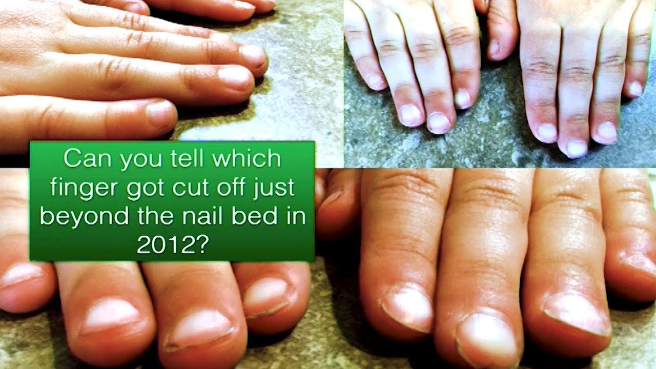 Finger regeneration by the power of God's healing herbs - YouTube
