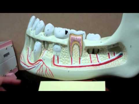 ROOT CANALS AND DEEP CAVITIES - YouTube