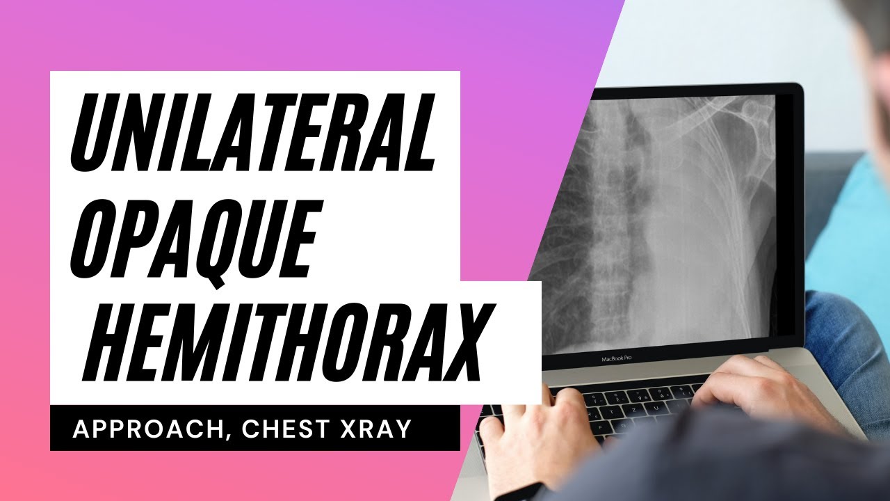 Approach to Unilateral White-out Lung - YouTube