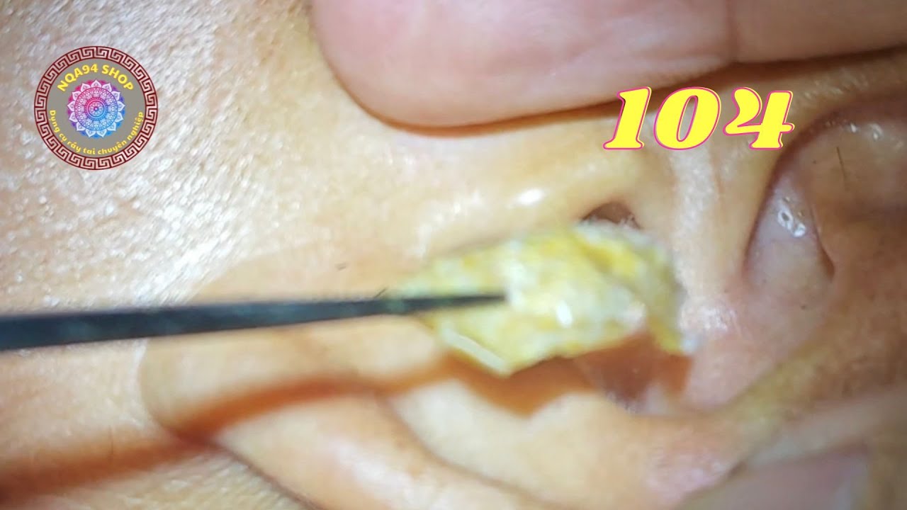 Lấy ráy tai không khó. Removing earwax is not difficult. 104 #layraytai ...