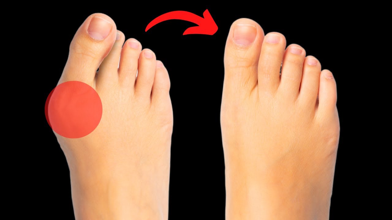 🔥 Vergessen Sie die Beule am Fuß und der hervorstehende Knochen wird ...