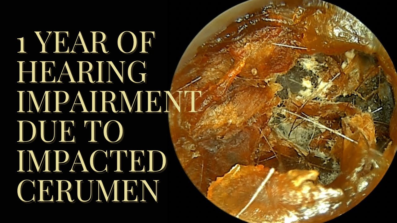 1 YEAR Of Hearing Impairment Due To Impacted Cerumen - YouTube