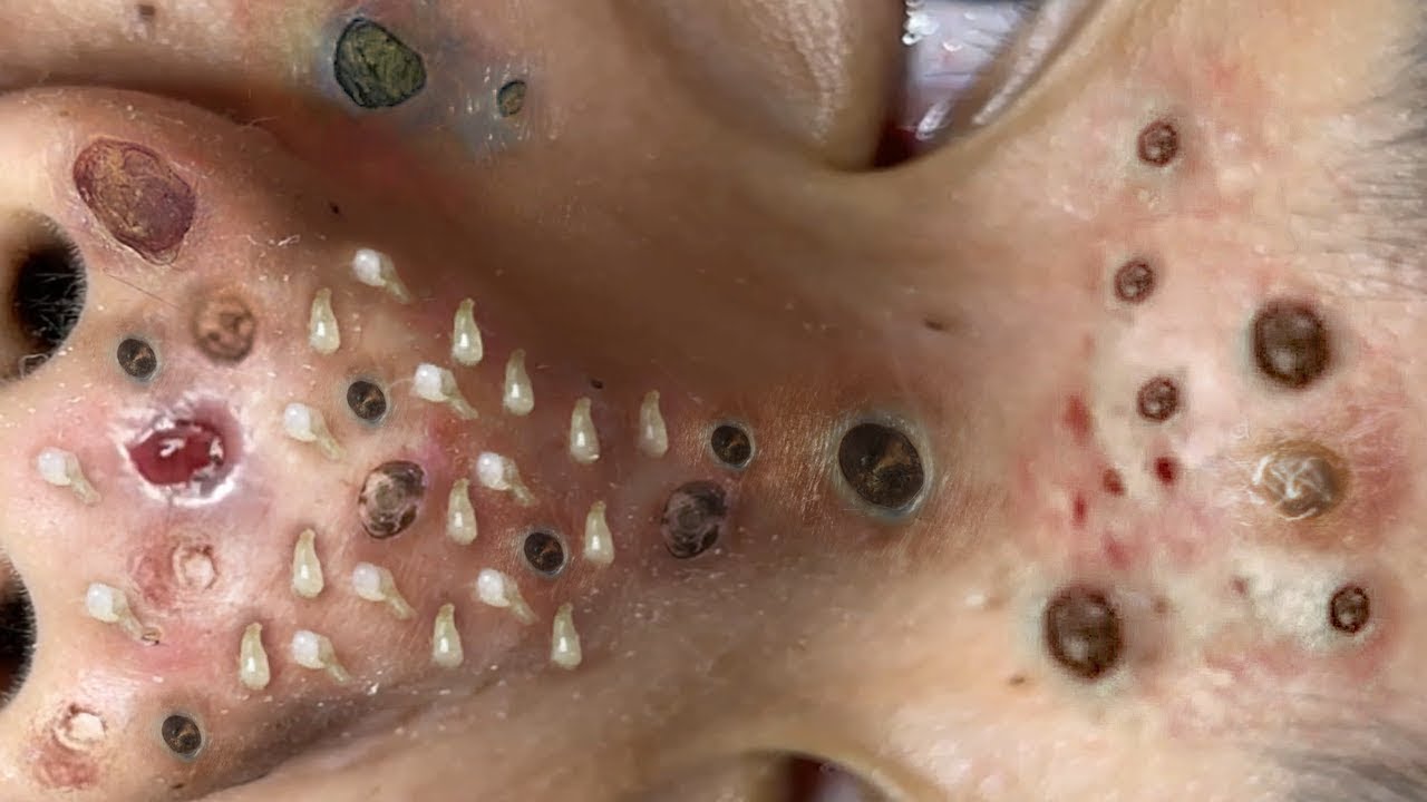 Make your Acne Treatment | Acne spa 995 | Acne spa Treatment - YouTube