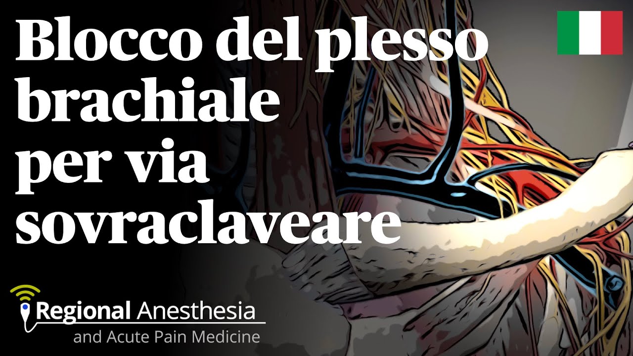 Blocco del plesso brachiale per via sovraclaveare - YouTube