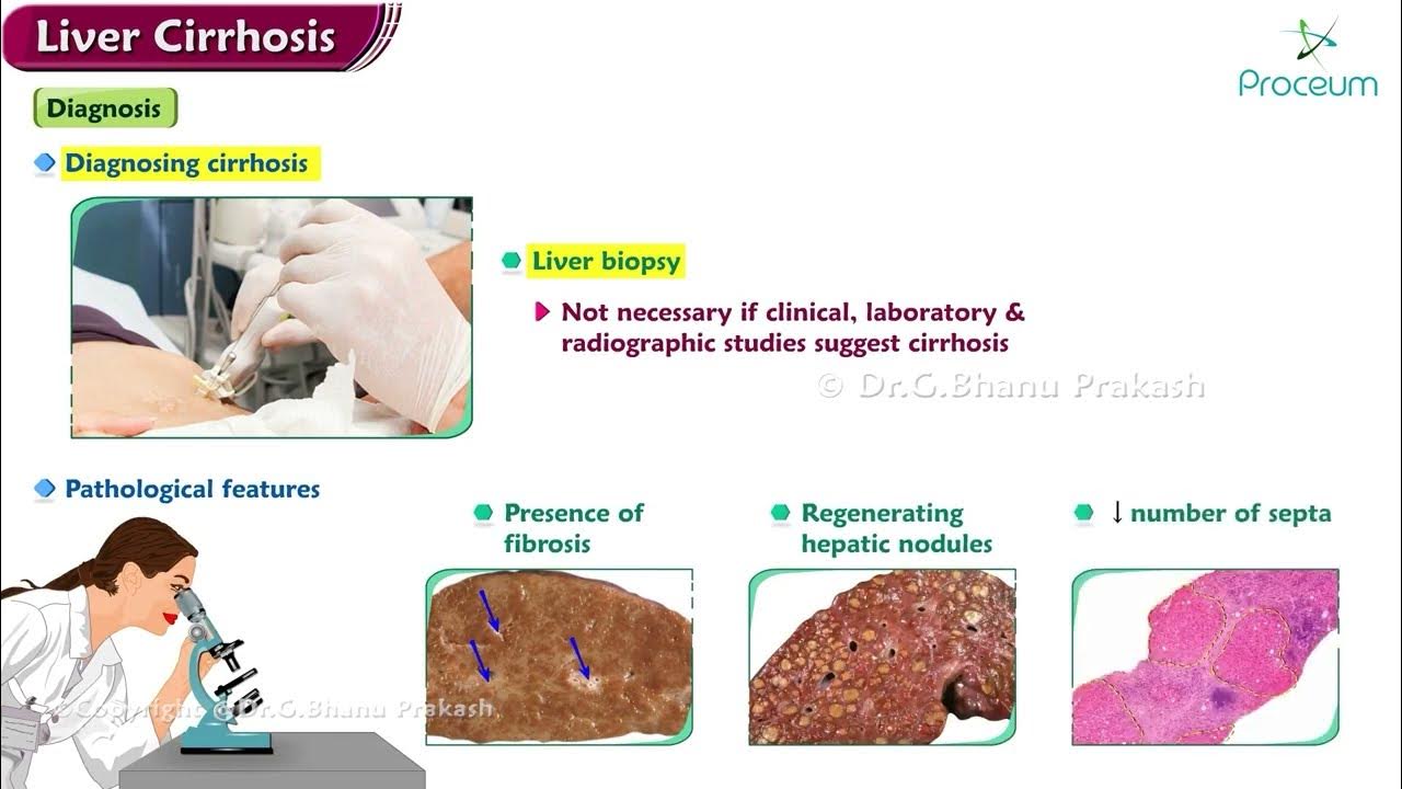 Liver cirrhosis : Etiology , Pathology , Clinical manifestations , Diagnosis , Treatment - YouTube