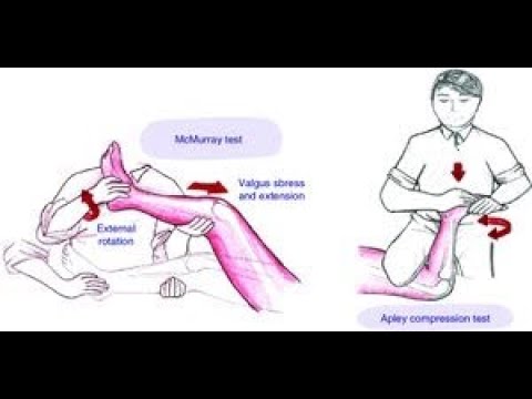 McMurray’s test for meniscus Tears; Medial meniscus test, Lateral ...