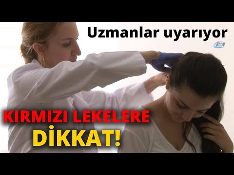 Vücudunuzda Hızlıca Yayılan Kırmızı Lekelere Dikkat