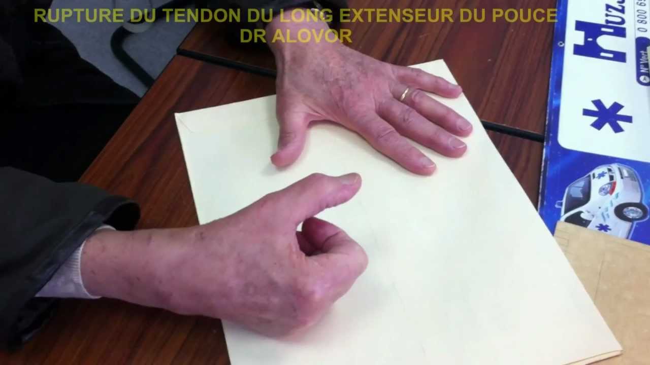 RUPTURE DU TENDON DU LONG EXTENSEUR DU POUCE DROIT - YouTube