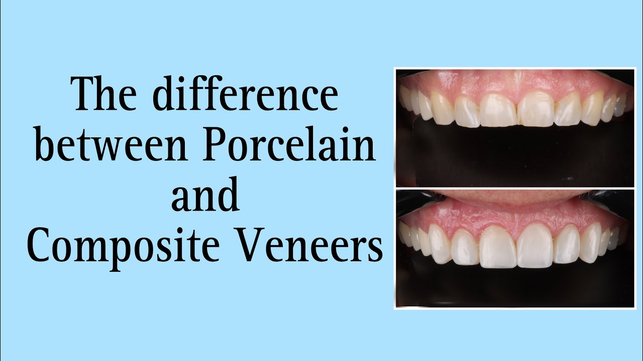 Difference between Porcelain Veneers and Composite Veneers - YouTube