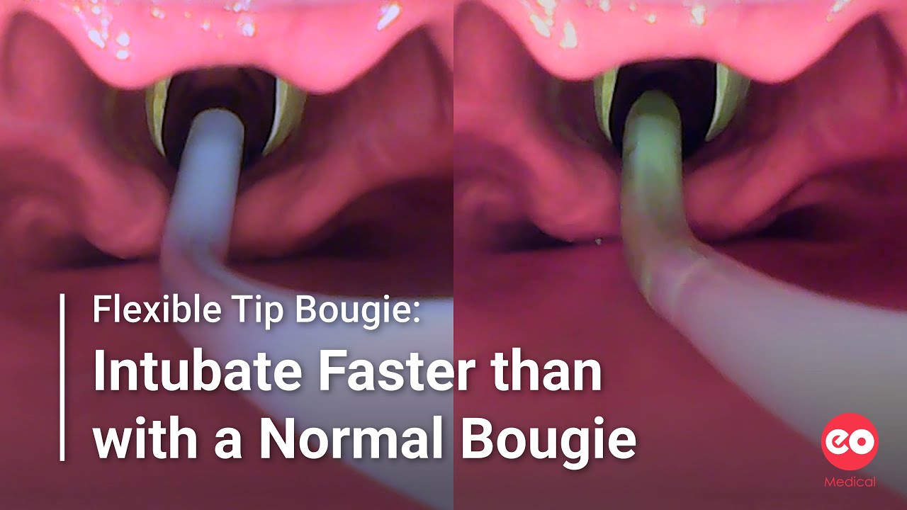 Flexible Tip Bougie: Intubate Faster than with a Normal Bougie - YouTube