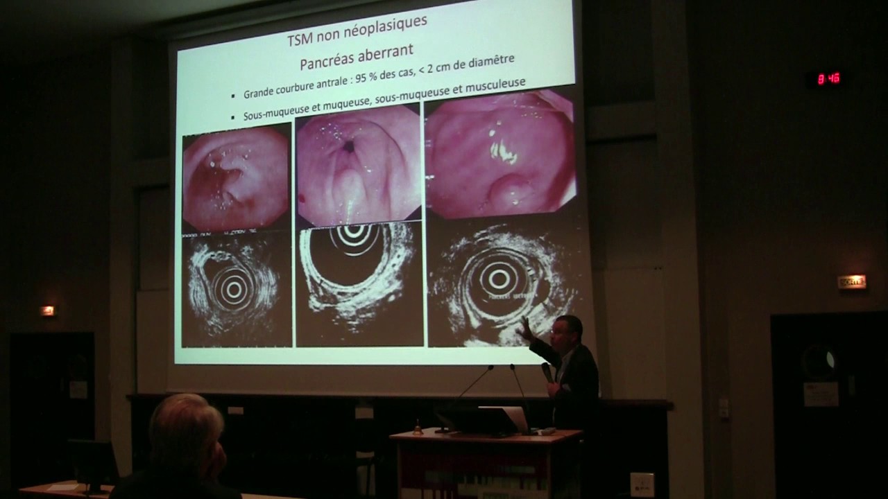 Aspect en endoscopie et écho-endoscopie des tumeurs sous-muqueuses ...