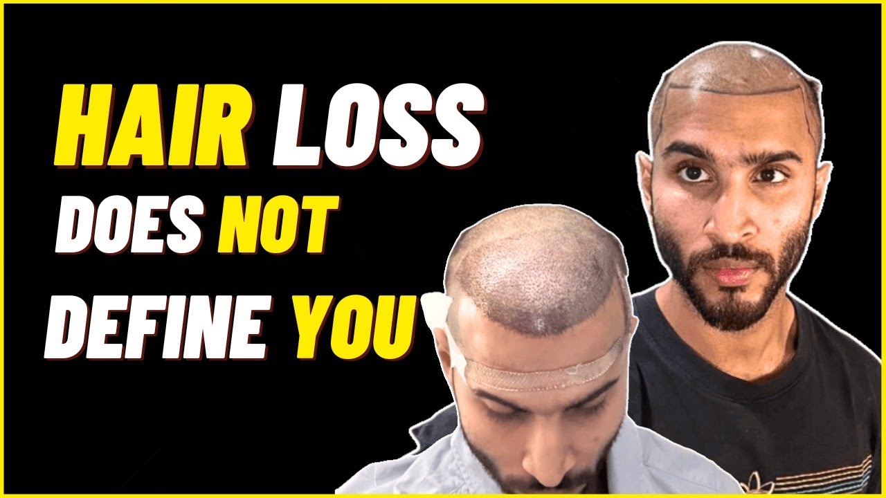 Complicated Hair transplant case | Diffuse pattern Male baldness ...