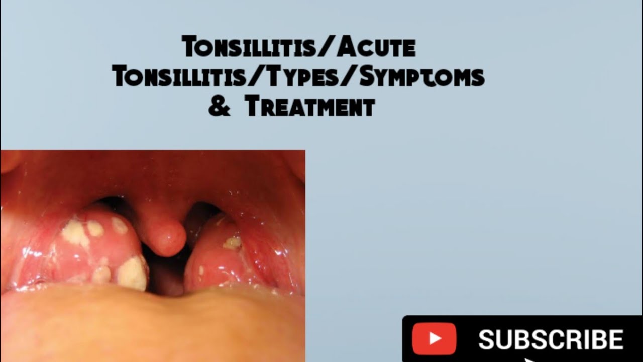 Acute Tonsillitis/Types/Cause & Treatment/#ENT lecture - YouTube