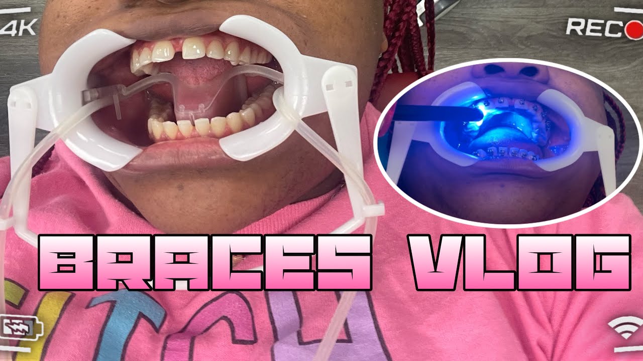 Come With Me To Get Braces|Vlog - YouTube