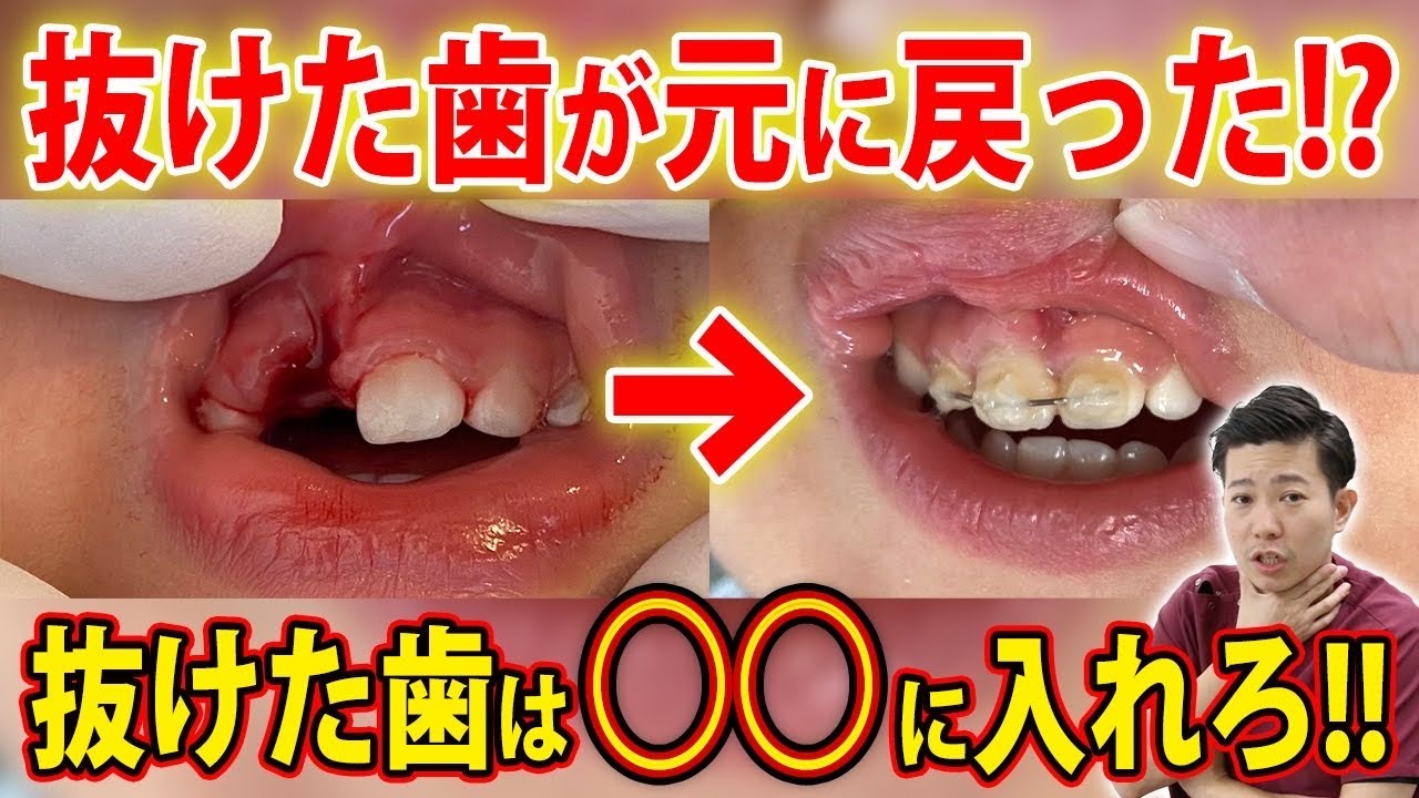 抜けた歯を元に戻す方法! Youtube