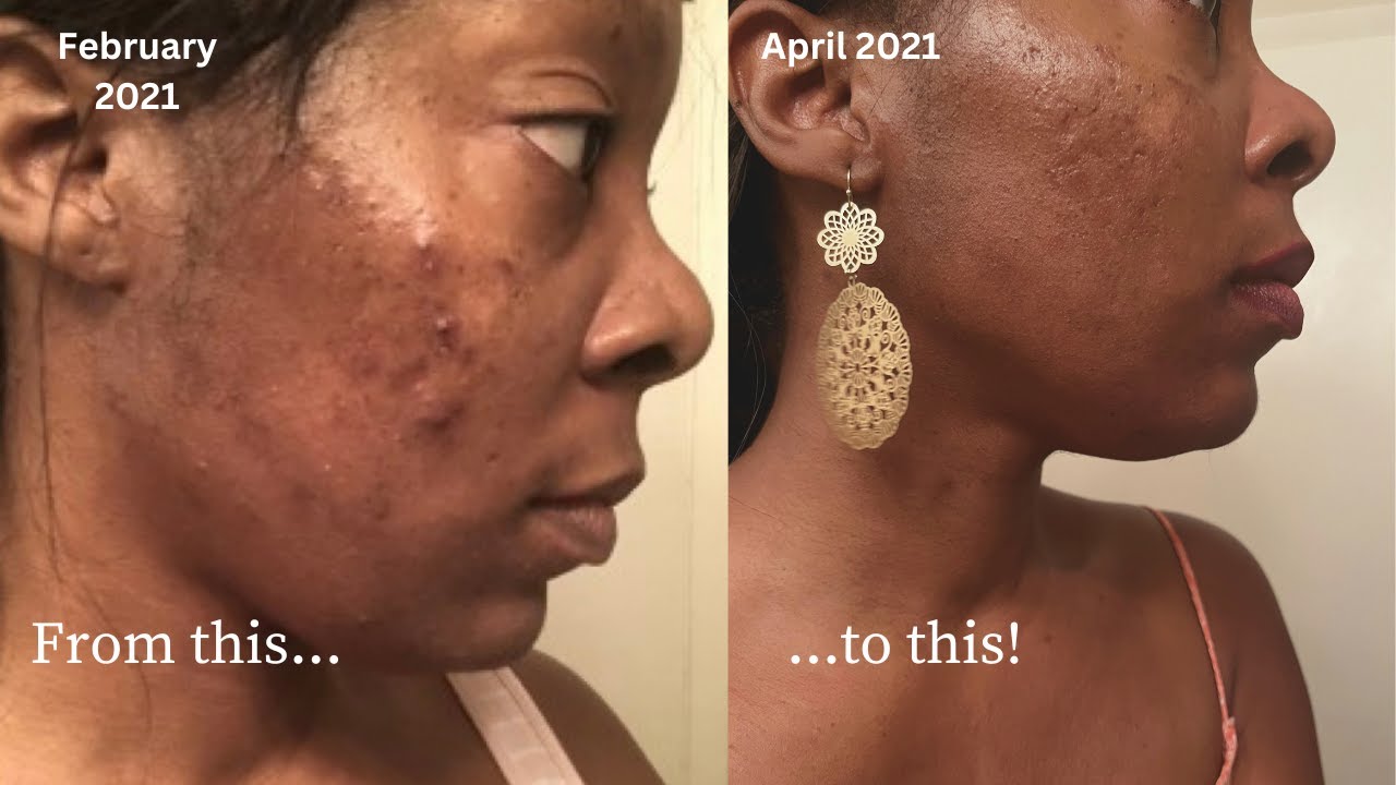 My Skin Care Journey How I Got Rid Of My Cystic Acne Youtube