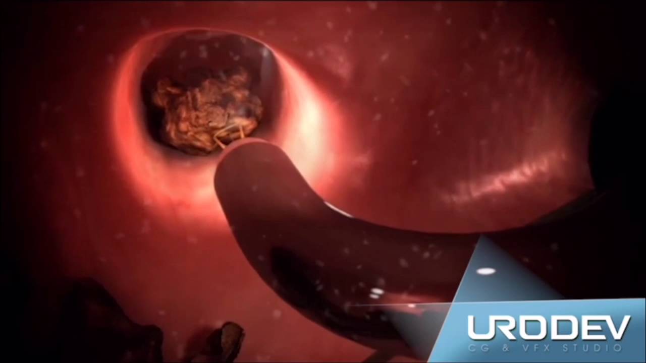 URETERORRENOLITOTRIPSIA FLEXIVEL LASER CALCULOS RENAIS FINAL - YouTube