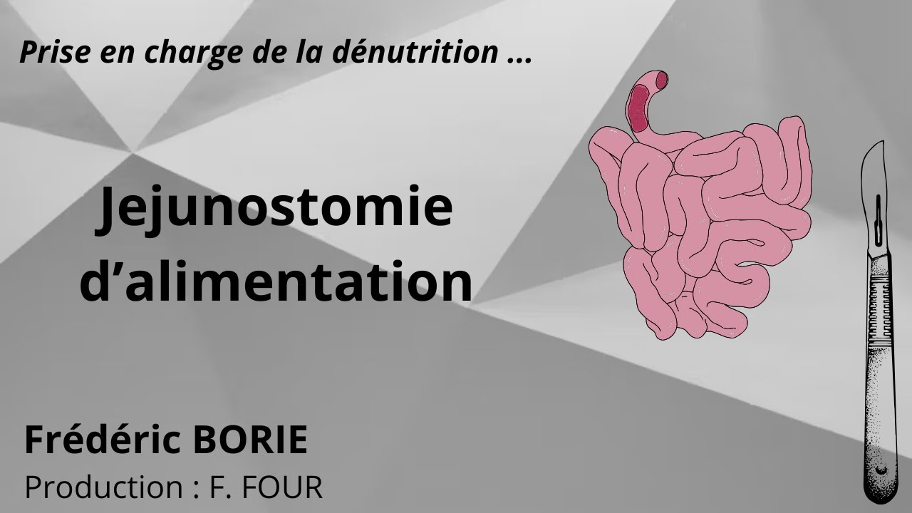 Pose de jéjunostomie d'alimentation - YouTube