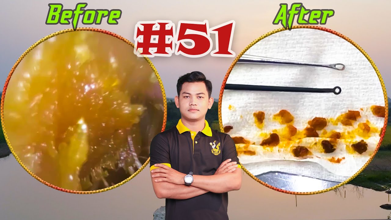 How to Remove Ear Wax Safely: Our Challenging Experience Eps51 - YouTube
