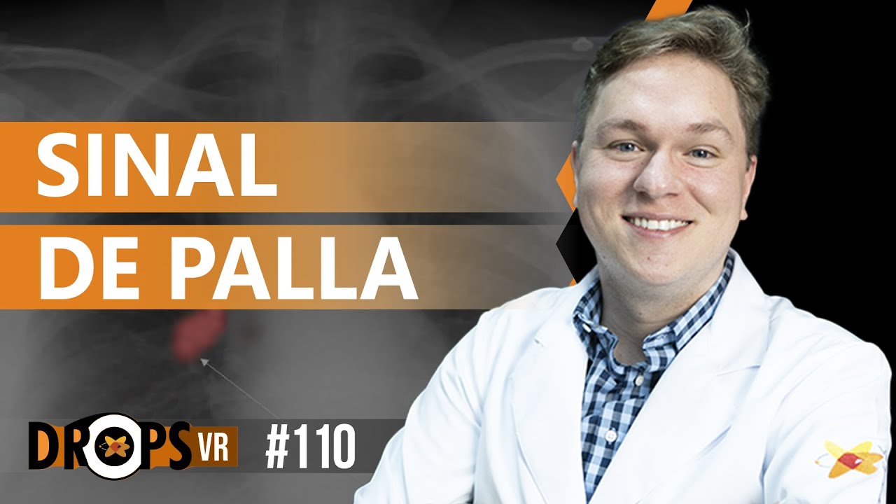 PROEMINÊNCIA DA ARTÉRIA PULMONAR INTERLOBAR (SINAL DE PALLA) - YouTube