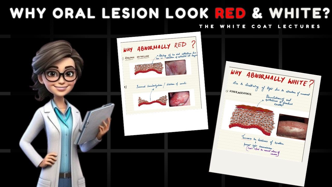 Introduction to Red & White Oral Lesions | High-Yield Oral Medicine ...