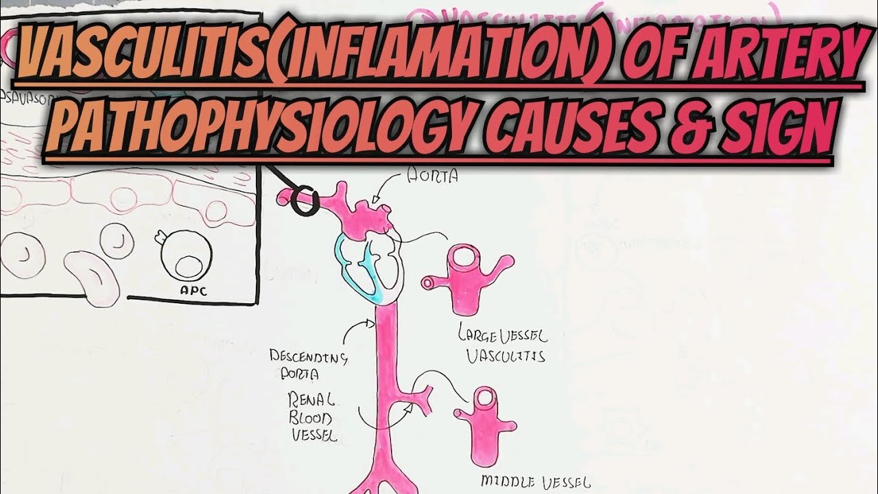 Understanding The Vasculitis(Inflammation) Pathophysiology Sign And ...