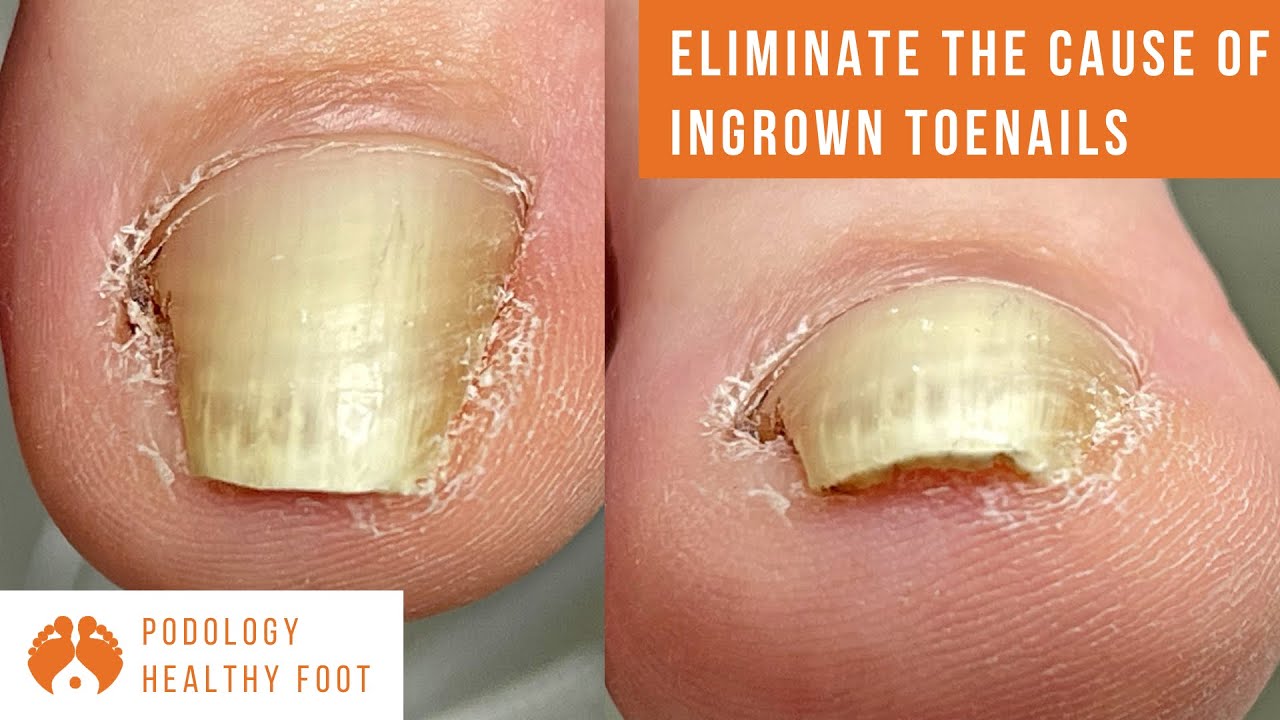 Eliminate the cause of INGROWN TOE NAILS by installing the "TITANIUM ...