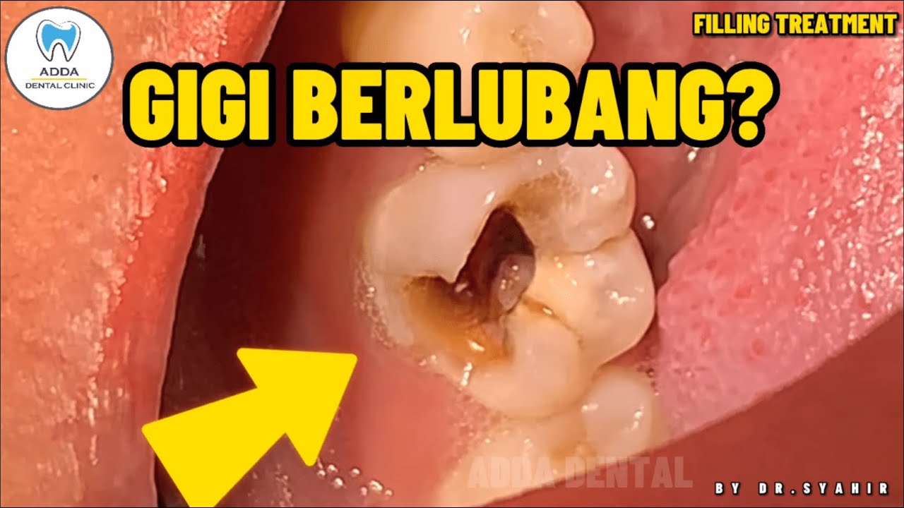 Gigi Berlubang | Tampalan Gigi | Fillings | Dentist | Adda Dental ...