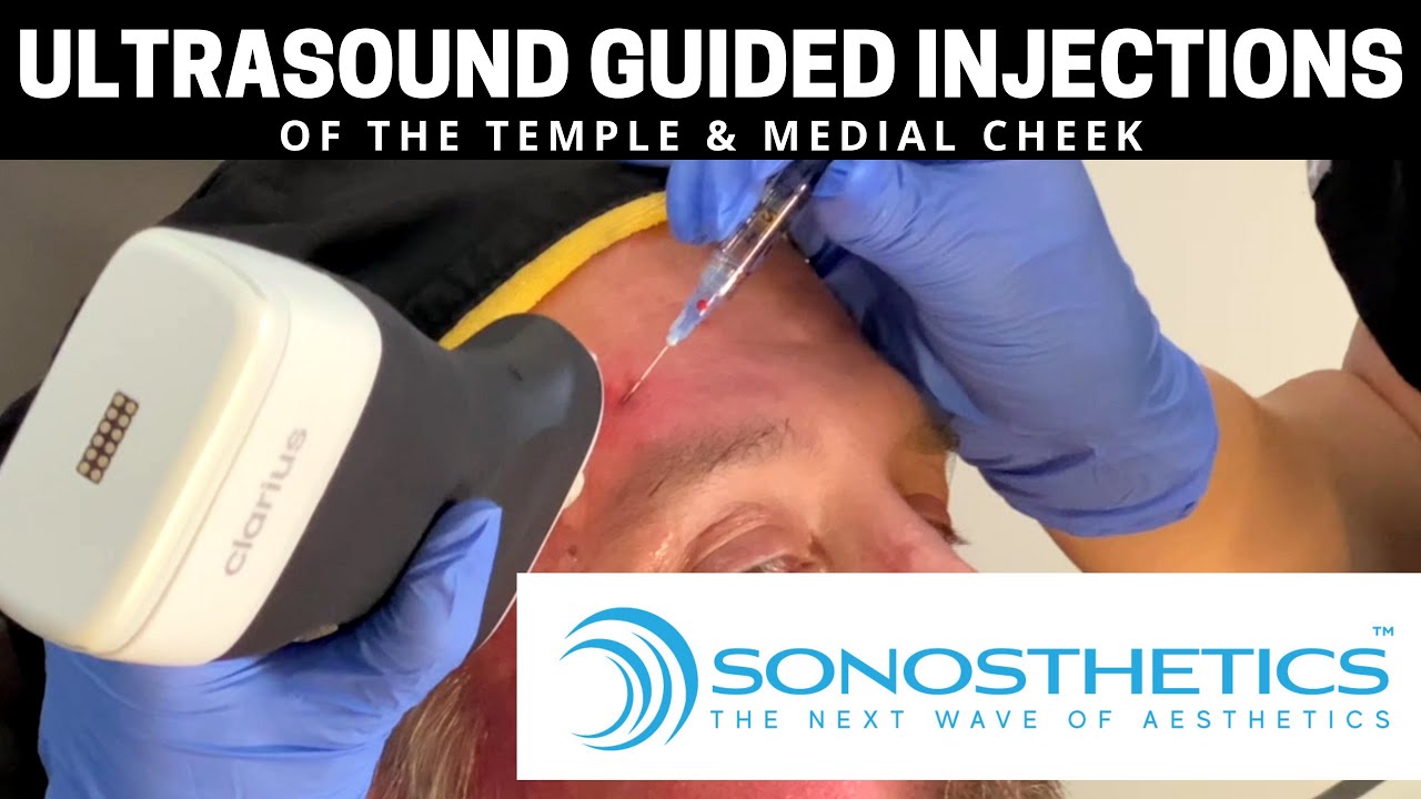 Ultrasound Guided Injections Of The Temple & Medial Cheek - YouTube