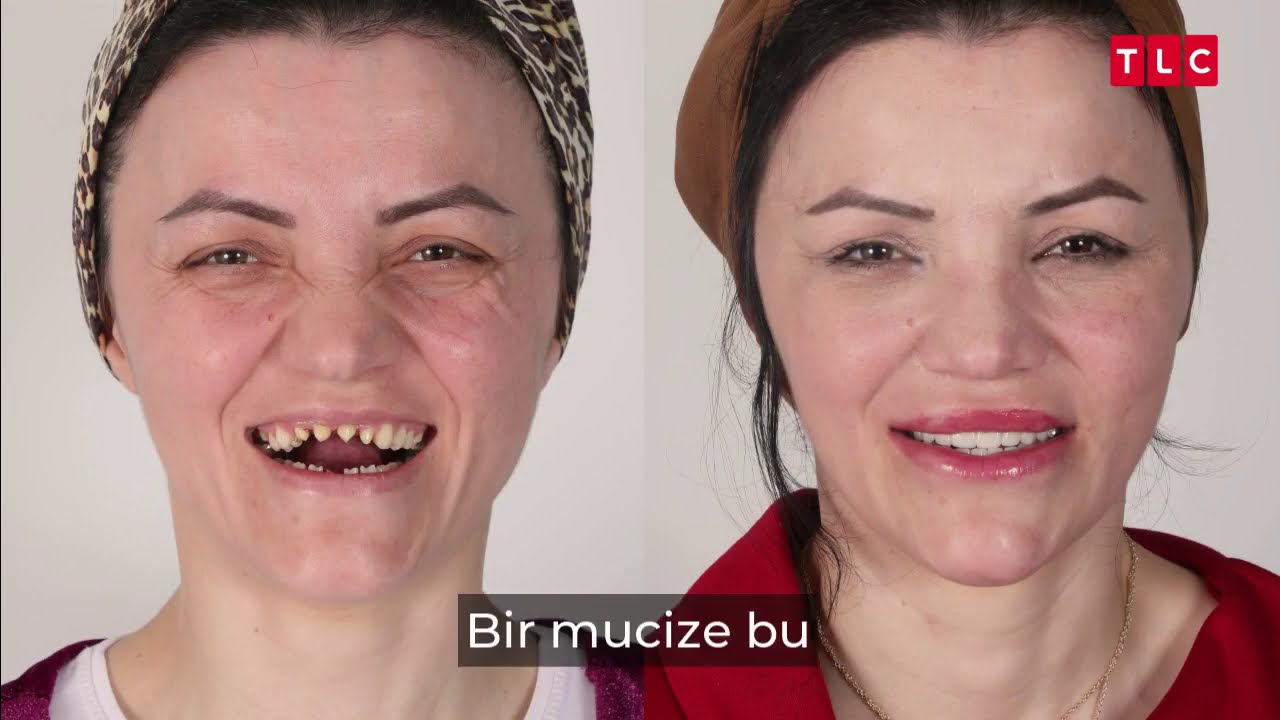 TLC / Doctor B / Cihantimur Fat Transfer System with Fat Juice / Full ...