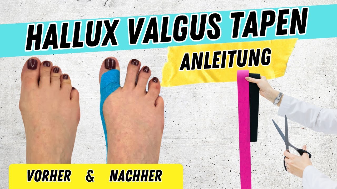 HALLUX VALGUS TAPEN ANLEITUNG | So kannst du einen HALLUX VALGUS TAPEN ...
