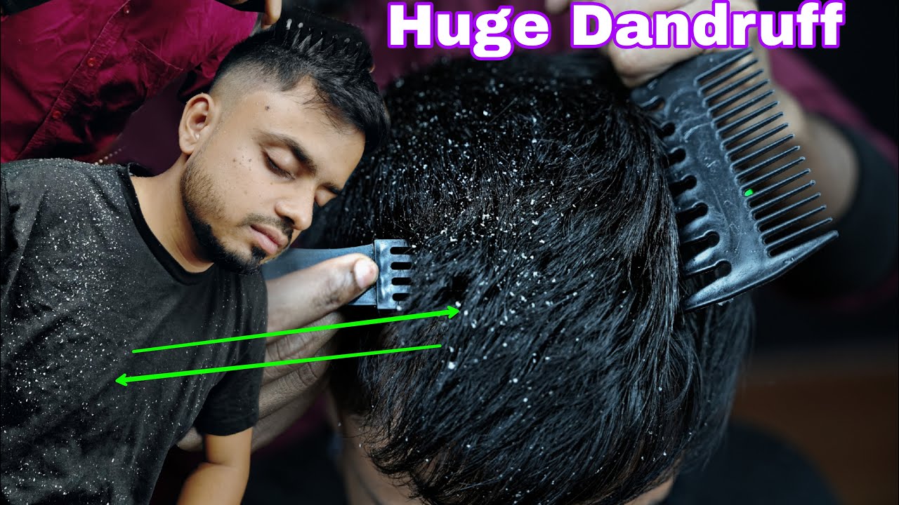 Huge Dandruff Removal From Sculp | ASMR Dandruff Scratching ...