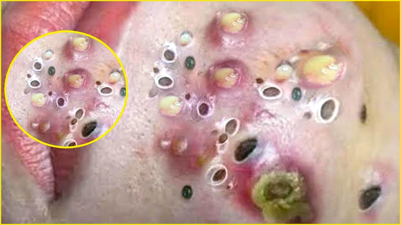 Botfly Maggot Removal Inflammatory Acne Relax Every Day With Satisfying ...