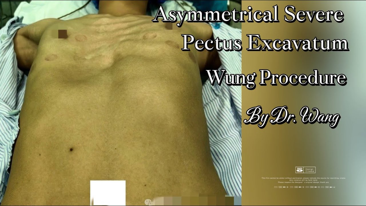 Asymmetrical Severe Pectus Excavatum, Wung Procedure - YouTube