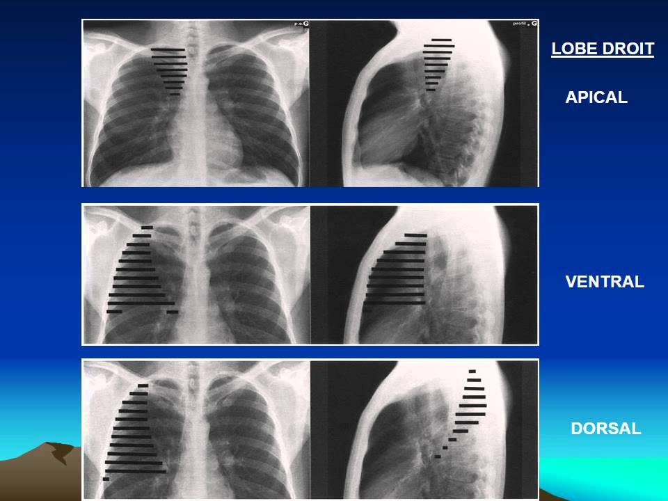 RADIOLOGIE ANATOMIE LOBAIRE ET SEGMENTAIRE - YouTube