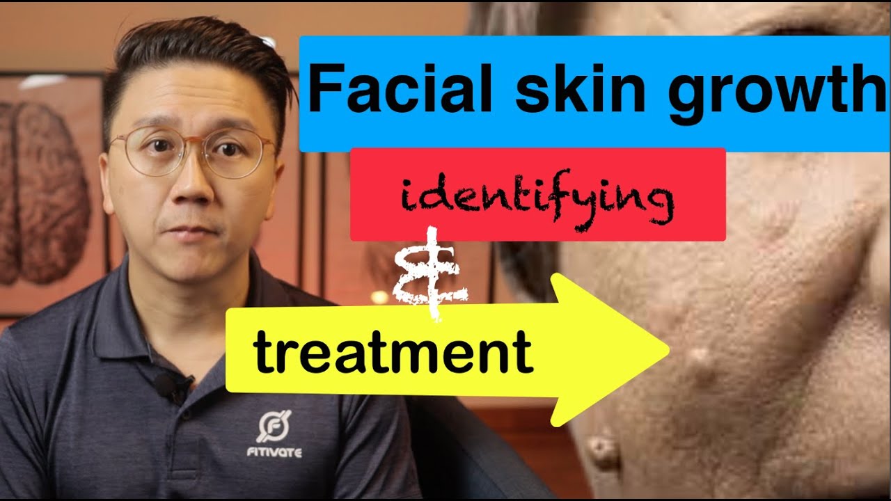Growths On YOUR Face Identifying And Treatment Part 1 2 YouTube growths-on-your-face-identifying-and-treatment-part-1-2-youtube