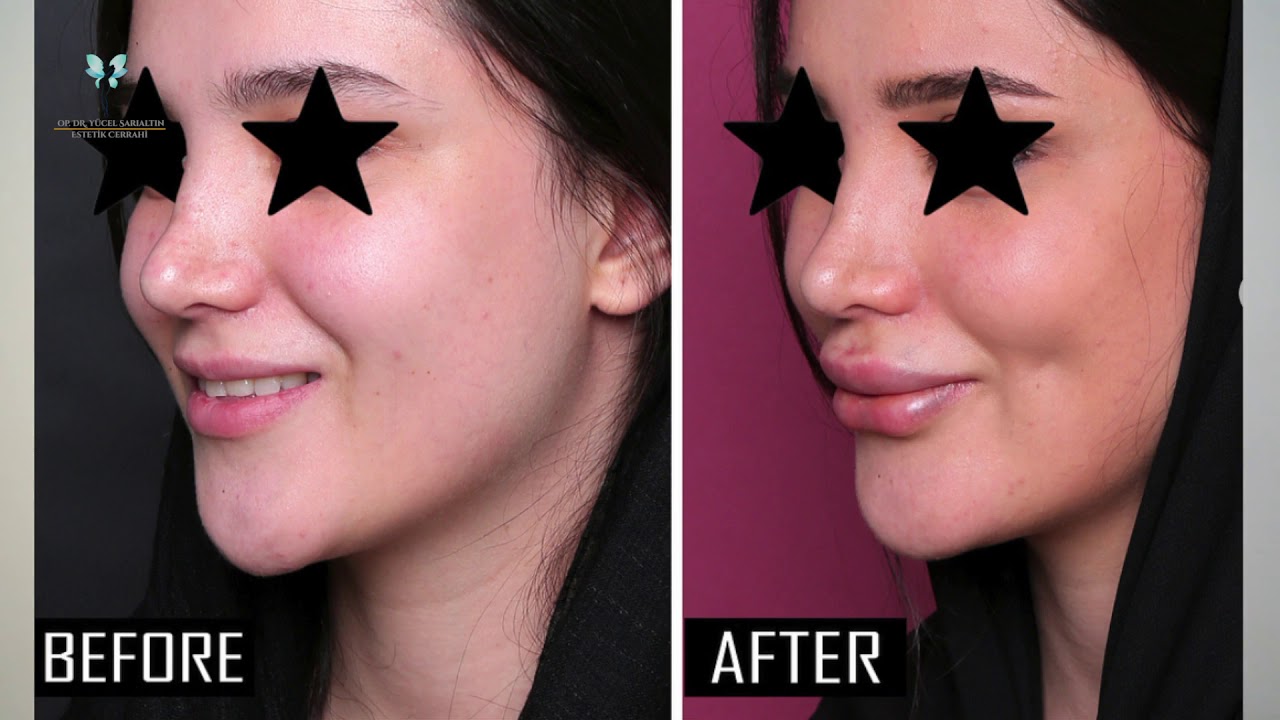 What Is Dimple Aesthetics? A Complete Guide! - YouTube