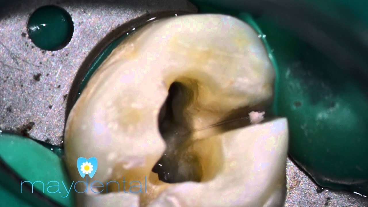 UL6 MB1/MB2 - YouTube