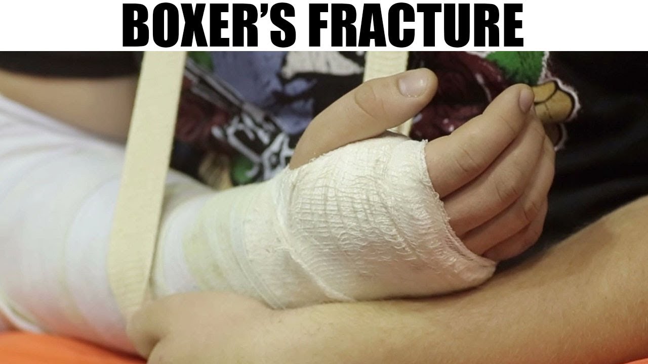 Boxer's Fractures! Everything You Need to Know! - YouTube