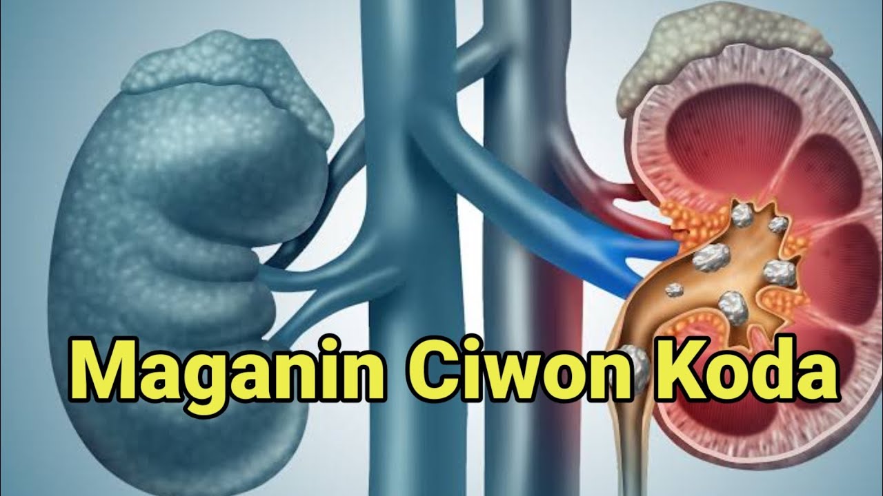 Abubuwan da suke jawo Ciwon Koda - YouTube