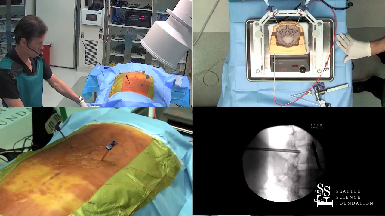 Tumor Ablation - Douglas Beall, MD - YouTube