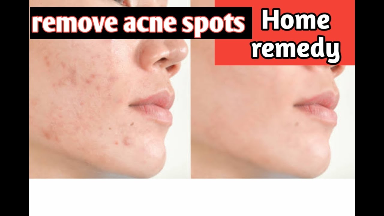 How to remove acne spots with home remedy. Dark spots, uneven skin tone ...