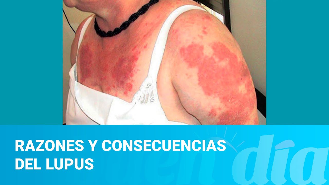 ¿Tiene lupus? Le explicamos las razones y consecuencias de la enfermedad - YouTube
