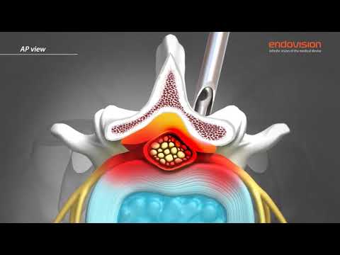Unilateral Biportal Endoscopy - New Approach for Spinal Surgery - YouTube