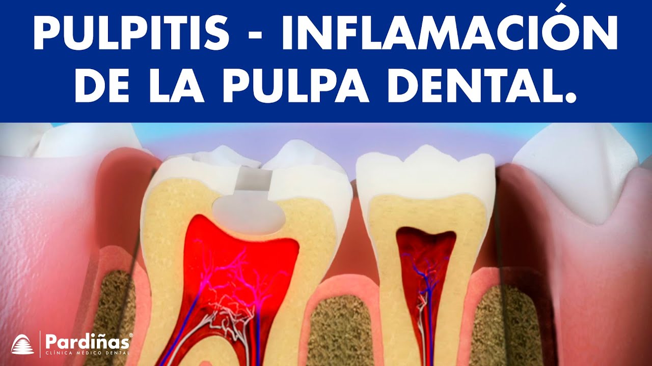 Pulpitis - Inflamación de la pulpa dental © - YouTube