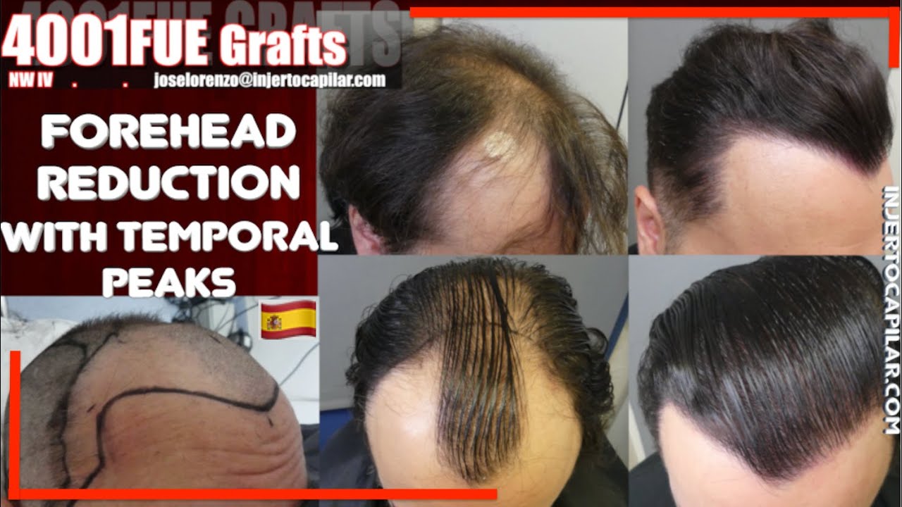 4001FUE Grafts. NW IV in 1 HT. Forehead reduction with temporal peaks ...