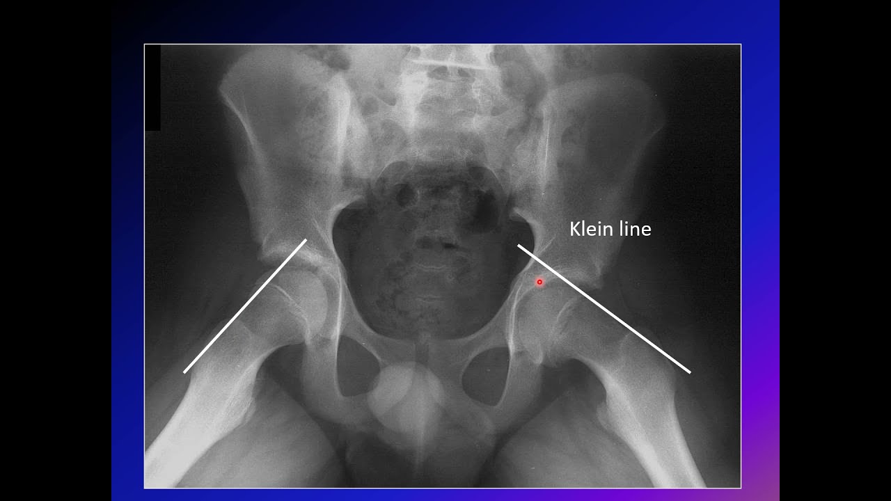 Slipped Capital Femoral Epiphysis (SCFE) - YouTube