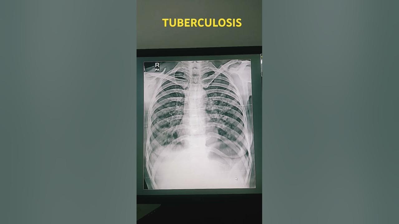 Xray Chest pa tuberculosis BVM hiller are prominent both lung koch ...