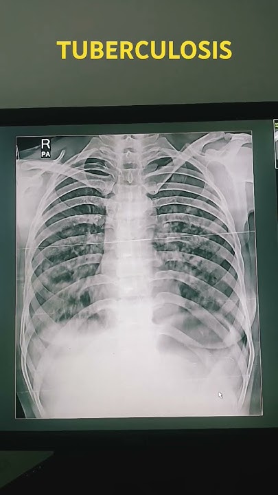 Xray Chest pa tuberculosis BVM hiller are prominent both lung koch ...